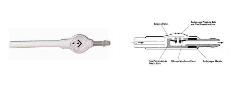Medtronic PS Medical Pressure Differential Valves - The ISPN Guide to ...