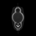 Medtronic PS Medical Pressure Differential Valves - The ISPN Guide to ...