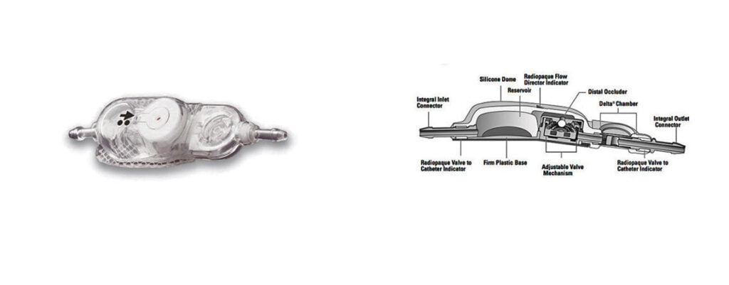 Medtronic PS Medical Adjustable Strata Valves - The ISPN Guide to ...