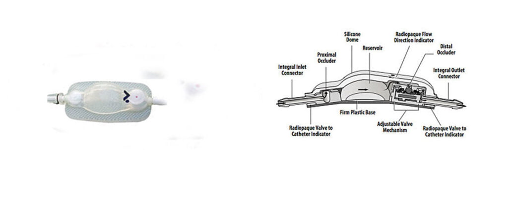 Medtronic PS Medical Adjustable Strata Valves - The ISPN Guide to ...