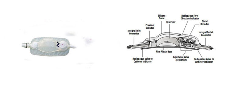 Medtronic PS Medical Adjustable Strata Valves - The ISPN Guide to ...