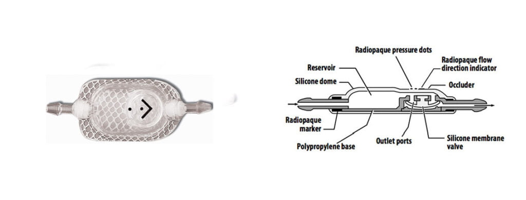 Medtronic PS Medical Pressure Differential Valves - The ISPN Guide to ...