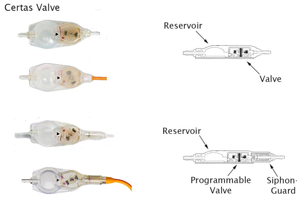 Codman Programmable Valves - The ISPN Guide to Pediatric Neurosurgery