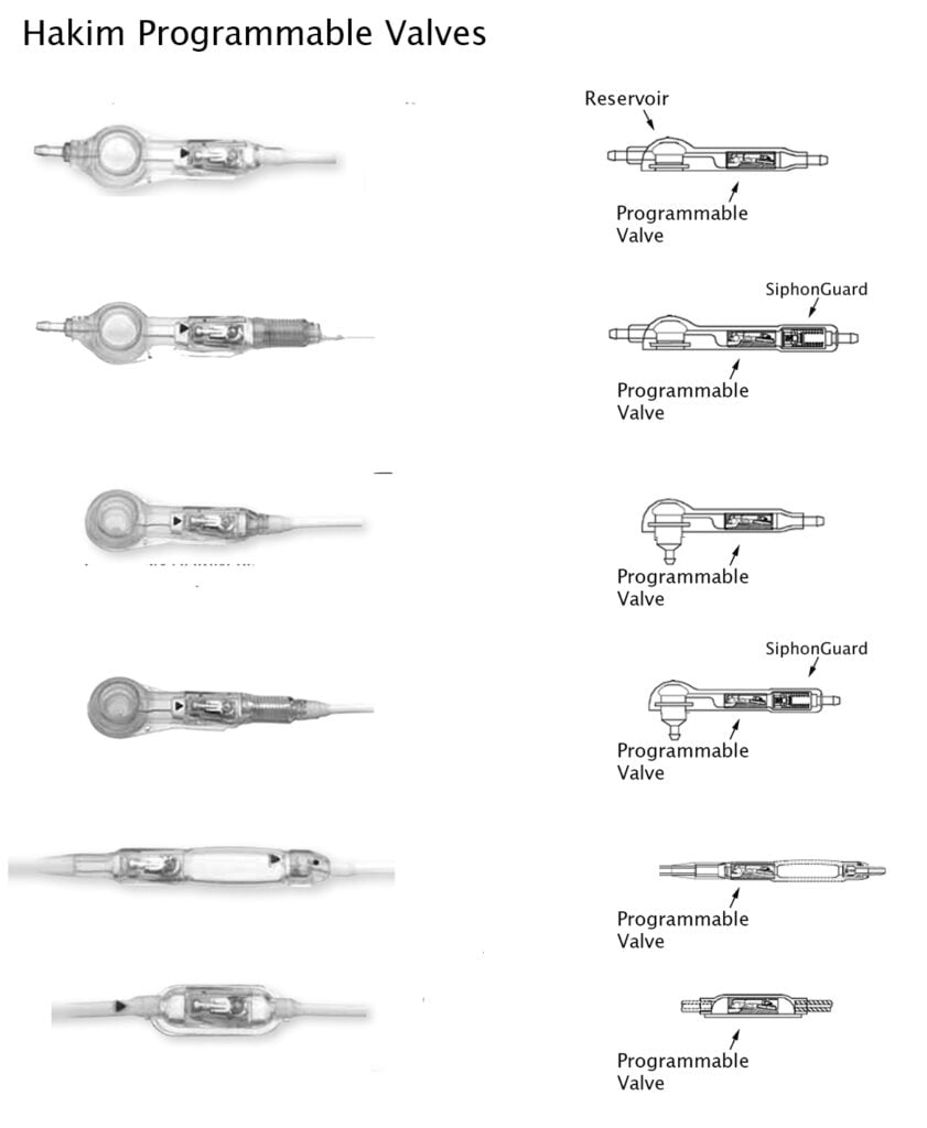 Codman Programmable Valves - The ISPN Guide to Pediatric Neurosurgery