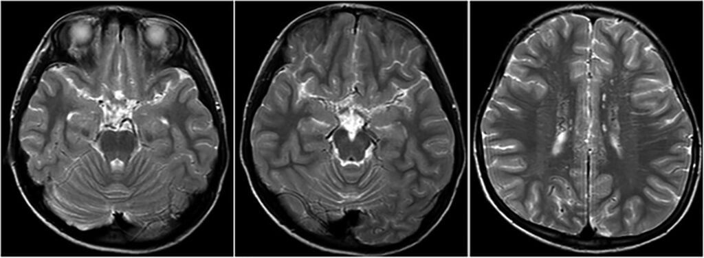 Evaluation of Moyamoya Disease in Children - The ISPN Guide to ...