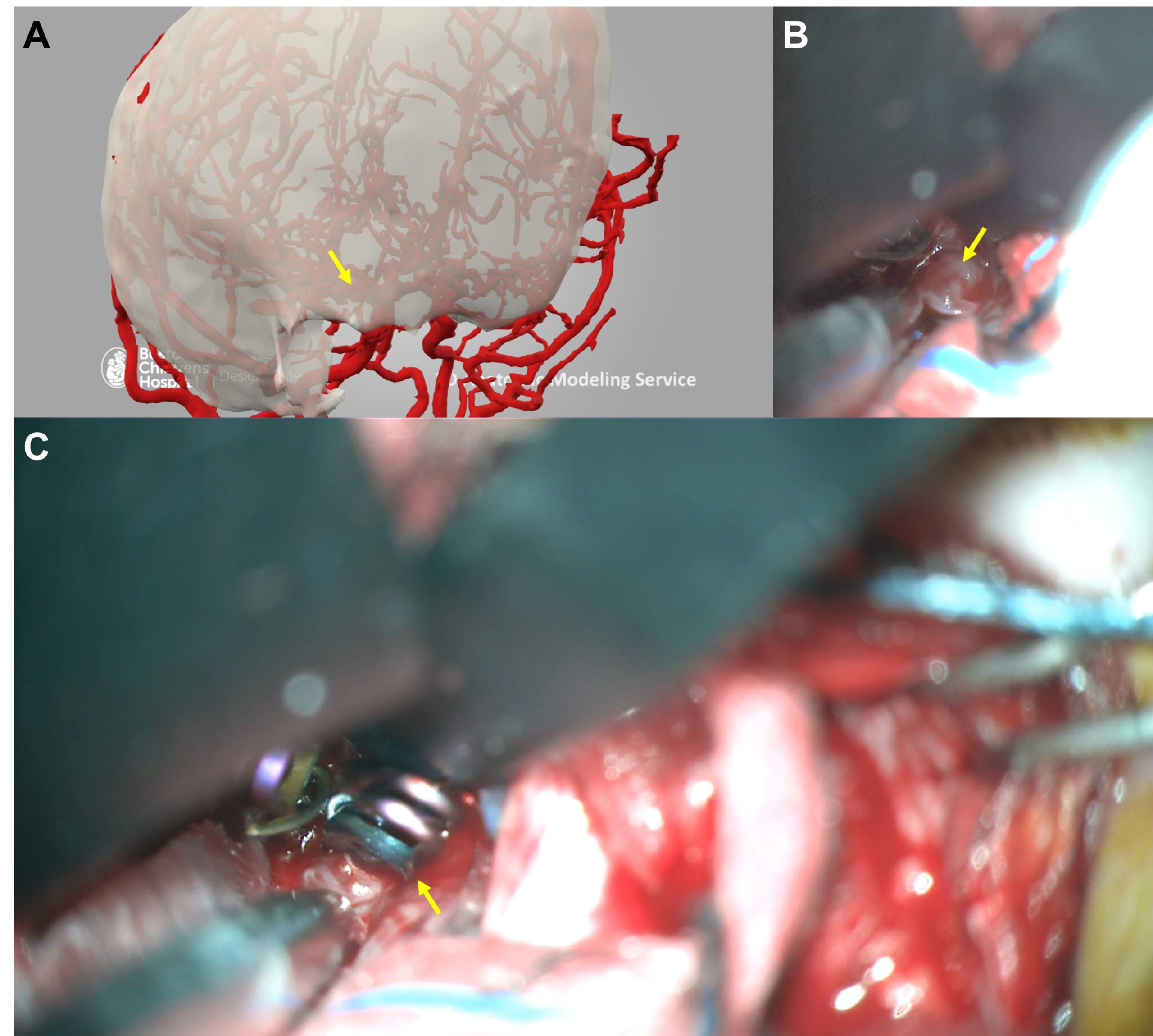 The Operation for Intracranial Aneurysms in Children - ISPN Guide