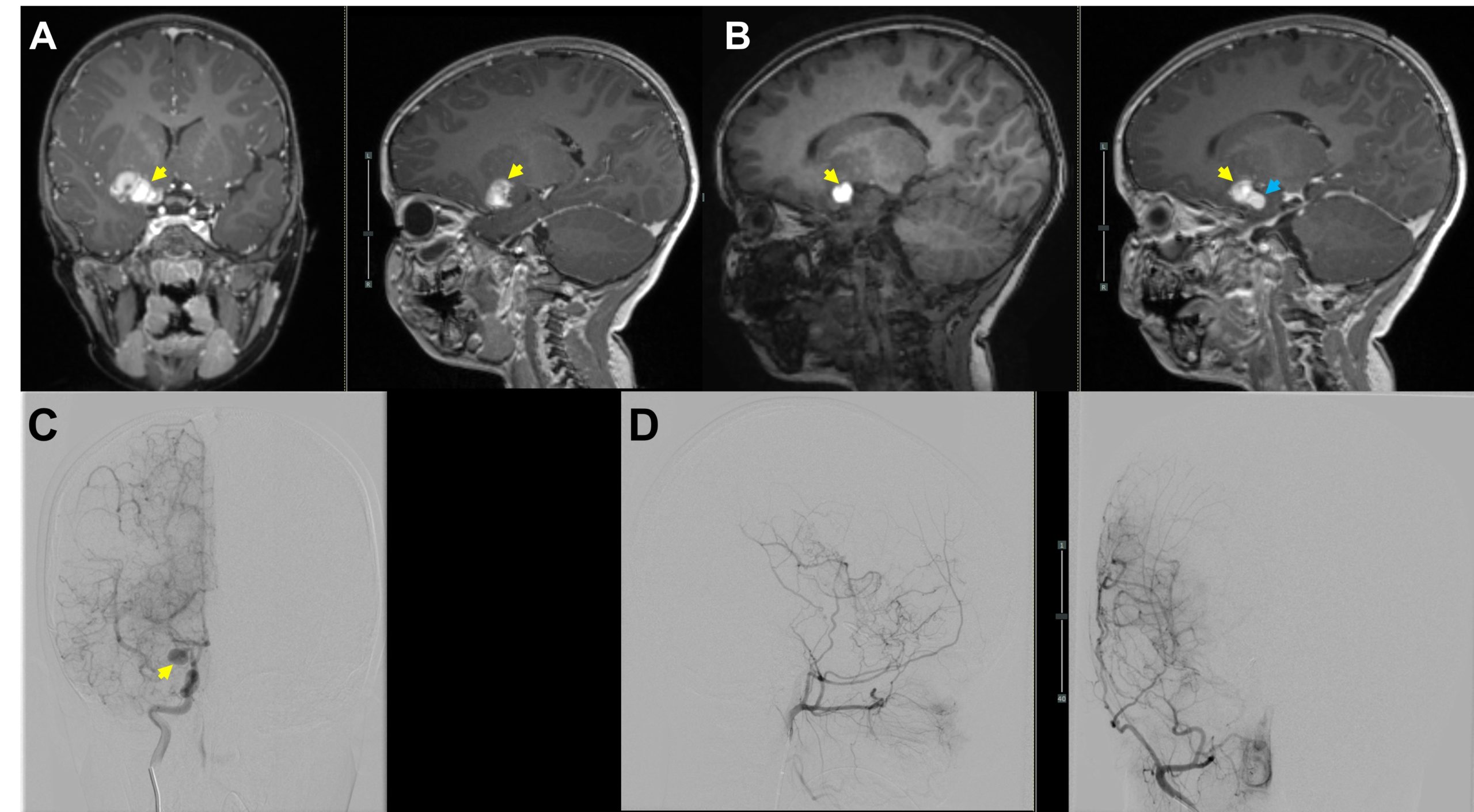 Pathology of Intracranial Aneurysms in Children - ISPN Guide