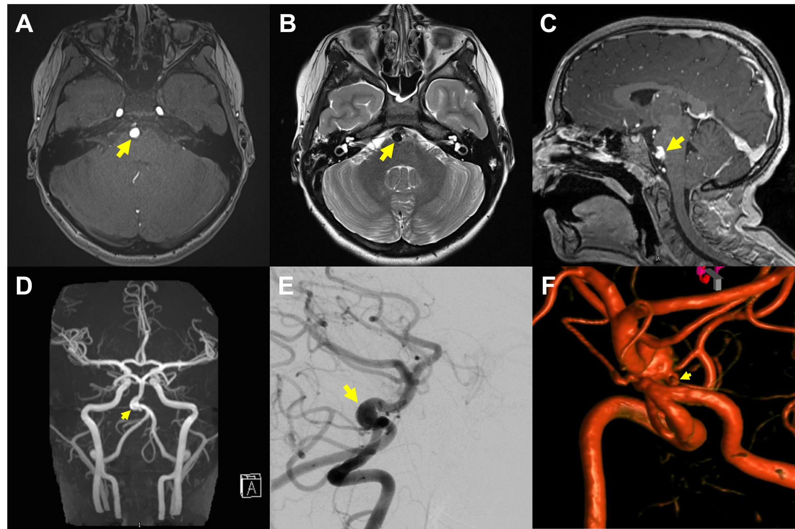 Evaluation of Intracranial Aneurysms in Children - ISPN Guide