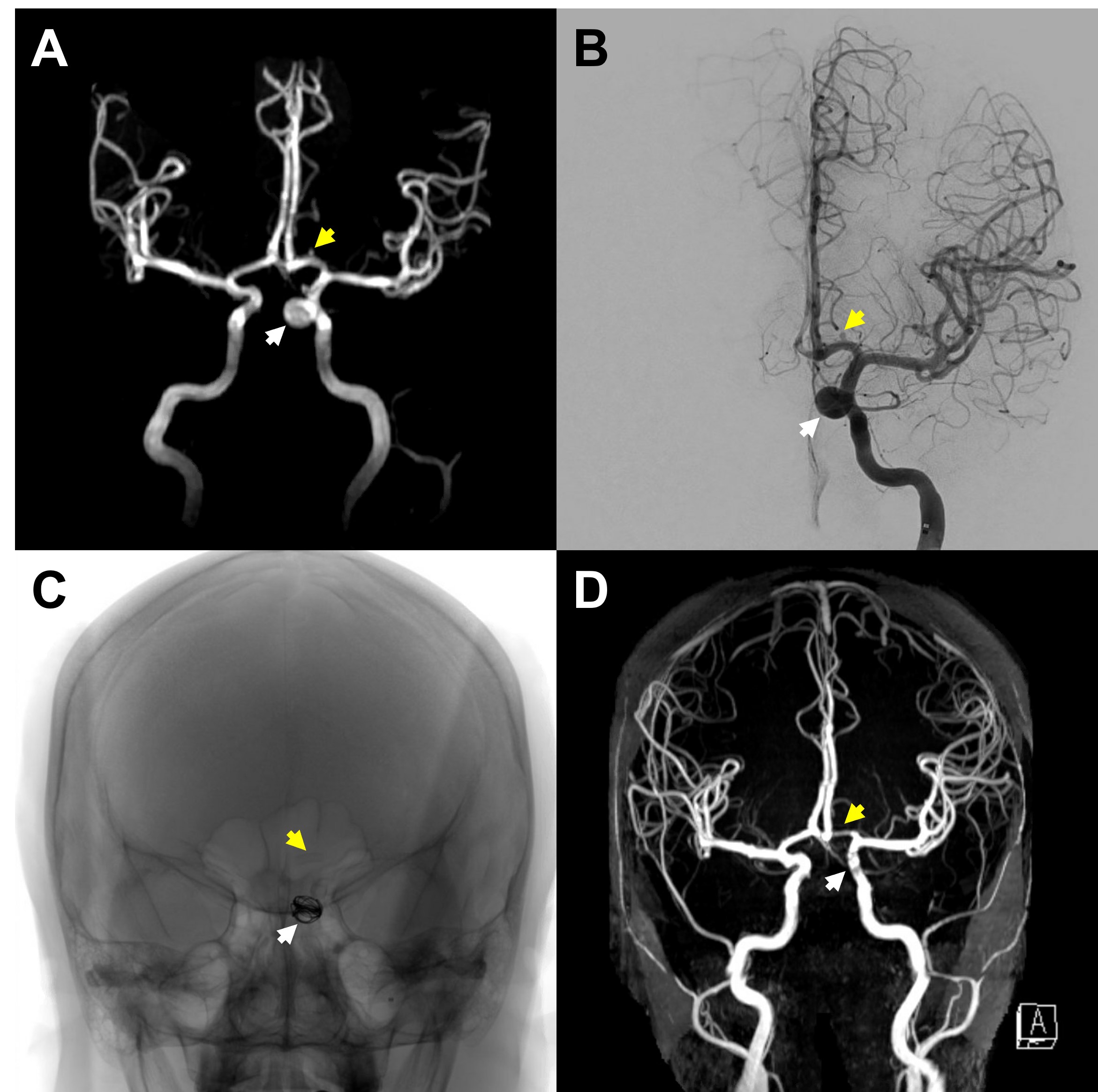 Epidemiology of Intracranial Aneurysms in Children - ISPN Guide