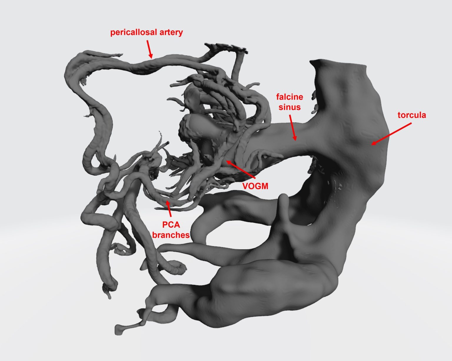 Pathology of Vein of Galen Malformations in Children - ISPN Guide